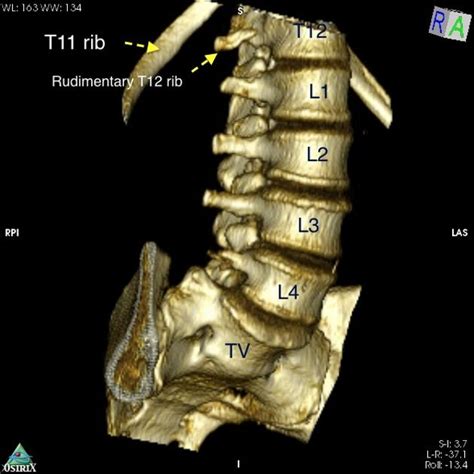 Sacralized L5 Segment Pacs