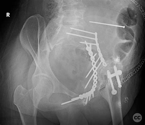 Associated Both Column Acetabular Fracture And A Femoral Neck Fracture With Oa