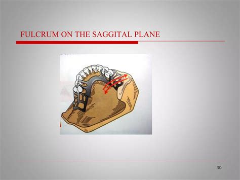 Designing For Kennedy Class I And Class Ii Ppt Oral Care Personal Care