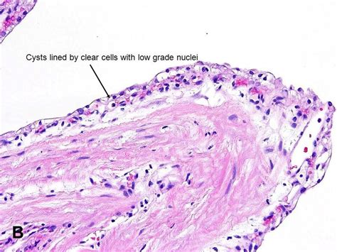 American Urological Association Multilocular Cystic Renal Cell Carcinoma