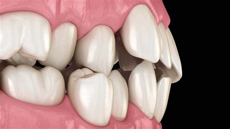 Top 5 Treatments For Dental Malocclusion