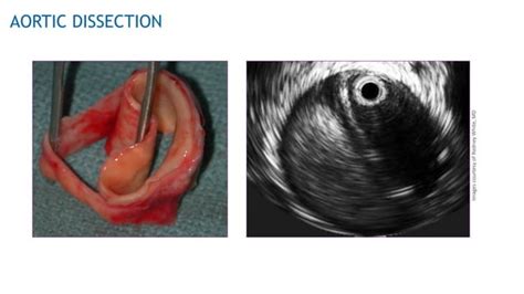Fujitani Utility Of Ivus In Complex Aortic Dissections Vnvda 2023 Pdf