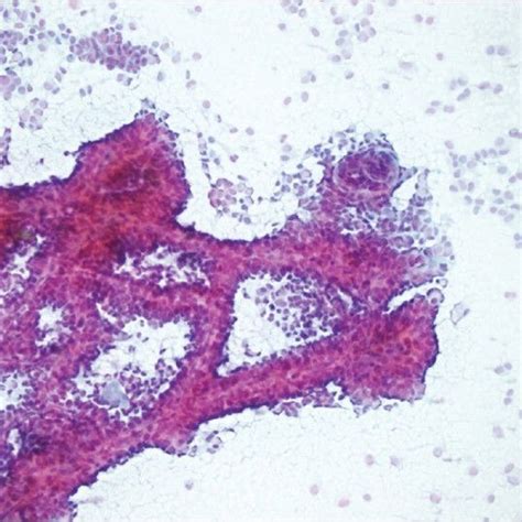 Vacuoles Can Be Seen Often And Easily In Diff Quik Stained Smears
