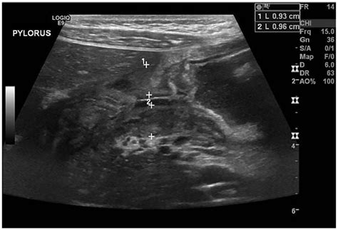 Pylorus Ultrasound