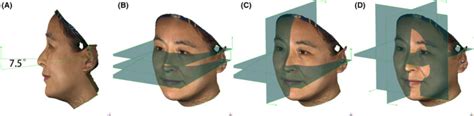 Stereophotogrammetry To Reveal Agerelated Changes Of Labial Morphology Among Chinese Women