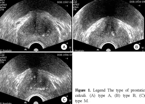 Figure 1 From Relations Between Prostatic Calculi And Lower Urinary