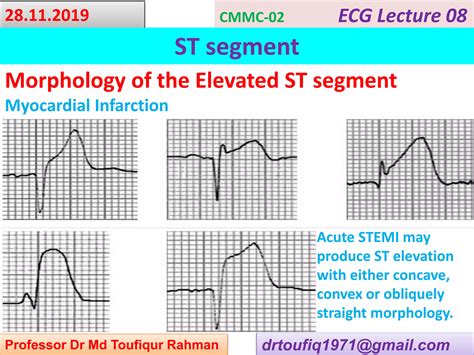 Ecg St Segment Ppsx