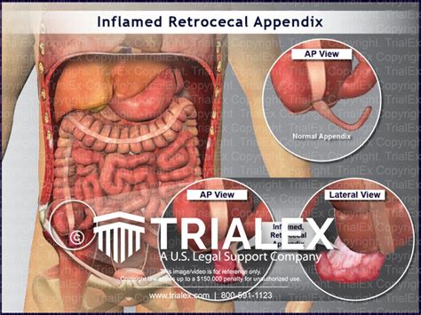 Inflamed Retrocecal Appendix Trialquest Inc