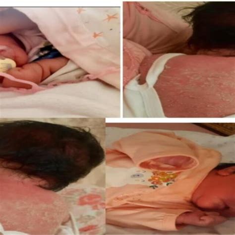 43 Days Old Girl Presented With Generalized Exfoliative Dermatitis Download Scientific Diagram