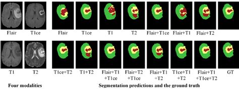 [논문 리뷰] A Multimodal Feature Distillation With Cnn Transformer Network For Brain Tumor