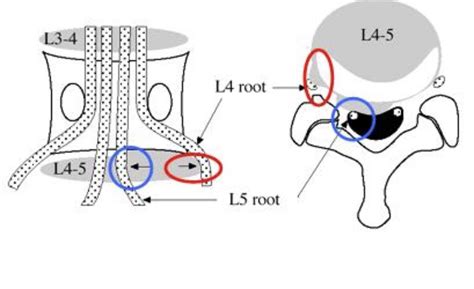 L4 5 Nerve Root Compression