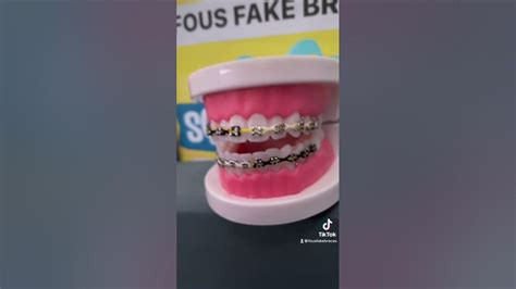 Spongebob Braces Fyp Fyp Fyp F Fyp Trending Fypviral Fousiyaunais Viral Youtube