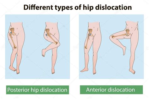 Hip Dislocation Stock Vector Image By ©marynamelnyk 71821565