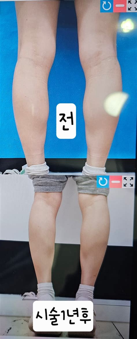 종아리 보톡스 지식in