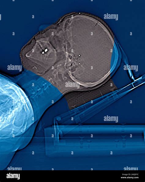 Radiotherapy For Brain Cancer Coloured Computed Tomography Ct Scan Of The Head Of A Patient