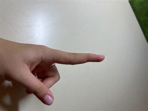 Почему искривлённый указательный палец на левой руке Вопрос ортопеду травматологу 03 Онлайн