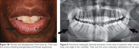 Figure 2 From Progressive Systemic Sclerosis An Extensive