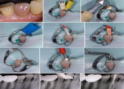 Endodontic Therapy Smilematters