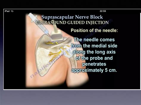 Shoulder Block Tutorial 2014 Ppt Shoulder Block Tutorial 2014 Ppt