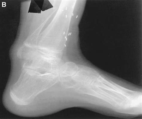 Patient Who Has Congenital Pseudarthrosis Of The Tibia With Cavus Foot Download Scientific