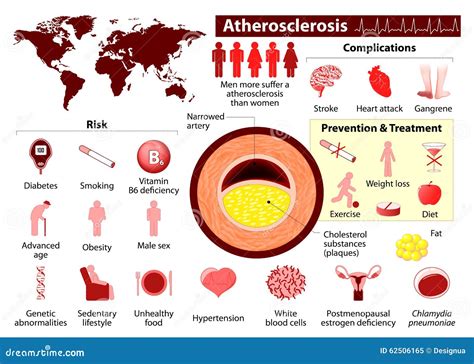 Atherosclerosis Infographics With Tiny Medic Characters Presenting