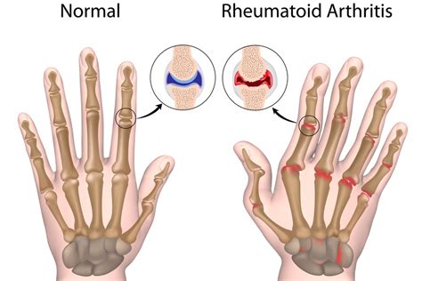 6 Types Of Arthritis Which Is The Most Common Morada Senior Living