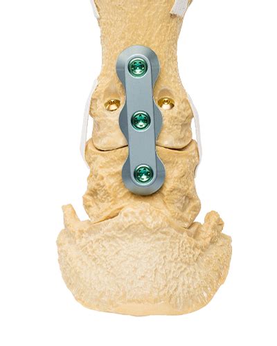 Pip Proximal Interphalangeal Arthrodesis Kyon
