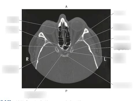 Axial Ct Of Anterior Clinoid Process And Sphenoid Bone Diagram Quizlet