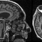 Morning Glory Sign Midbrain Pacs