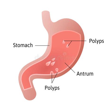 Flat Polyp Stock Illustrations 236 Flat Polyp Stock Illustrations
