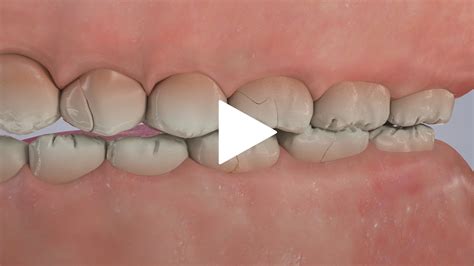 Dental Videos Staten Island Ny Ralph Tarantino Dmd