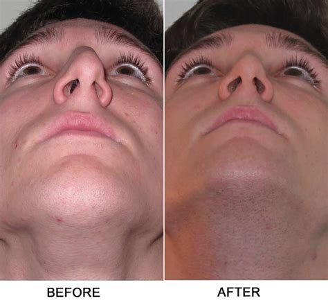 Nasal Septum Deviation