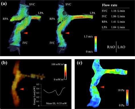 Flow Analysis In The Total Cavopulmonary Connection Tcpc Using Download Scientific Diagram