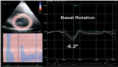 Basal And Apical Rotation Curves Showing The Peak Twist Degrees