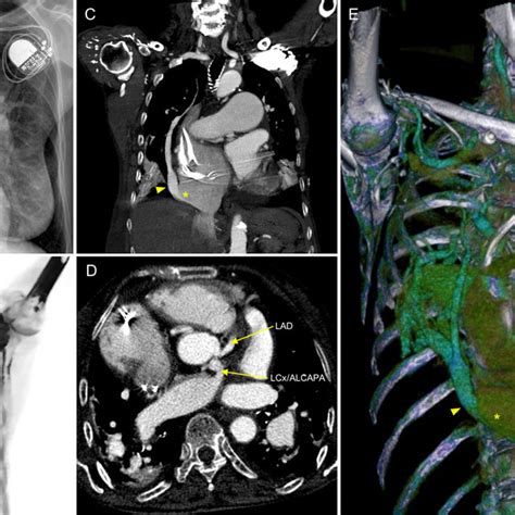 Color Doppler Displaying Sinus Venosus Defect Download Scientific
