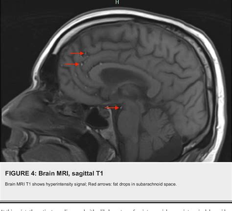 Figure 4 From An Unusual Presentation Of Spontaneous Rupture Of Dermoid
