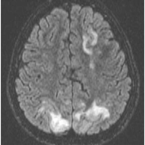 Axial Flair Images Show Abnormal Hyperintense Signal In The Bilateral Download Scientific