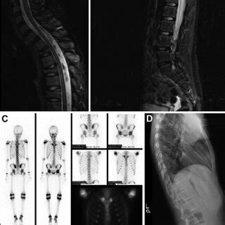 Case 6 Neuroimaging Demonstrating T11 Superior Endplate Compression Download Scientific