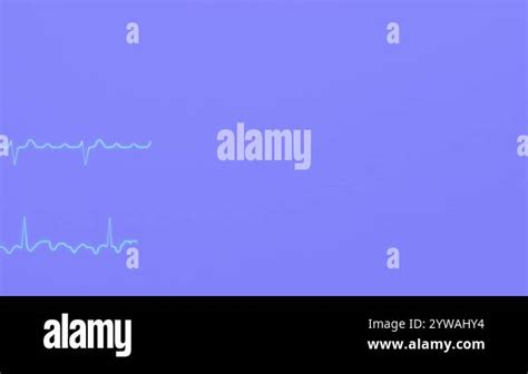 Ecg Graphs Of Regular And Irregular Atrial Flutter Stock Video Footage Alamy