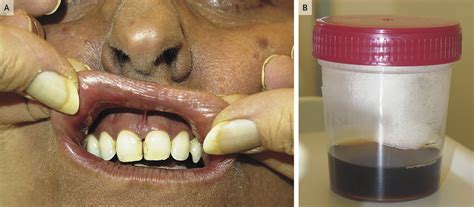 A Case Of Diffuse Melanosis And Melanuria