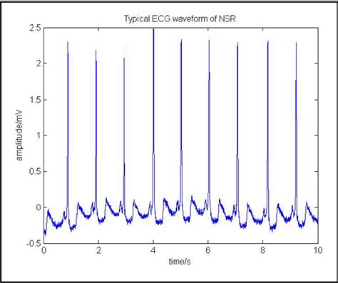 Figure 1 From A Shockable Rhythm Detection Algorithm Using Slope