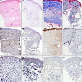 A A Representative Image Of Localized Scleroderma Specimen Revealing Download Scientific
