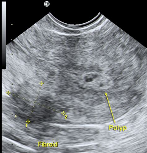 Endometrial Measurements Ultrasound At Jeanette Novack Blog