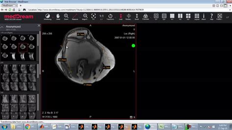 Bone Marrow Segmentation 3d Matlab Projects Youtube