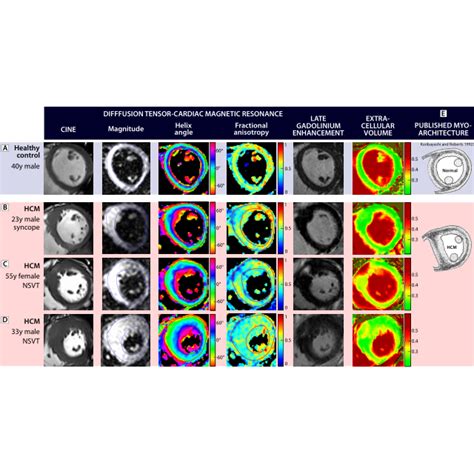 Diffusion Tensor Cardiac Magnetic Resonance Diffusion Tensor Cardiac