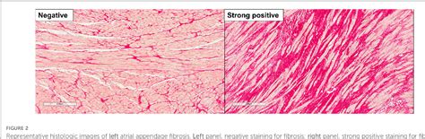 Figure 1 From Left Atrial Strain Predicts Fibrosis Of Left Atrial