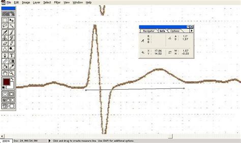 Measurement Of Qt Intervals By Adobe Photoshop Software Manually Download Scientific