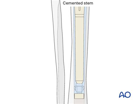 Proximal Tibia Replacement For Fracture Around A Loose Tibial Component With Good Bone Stock