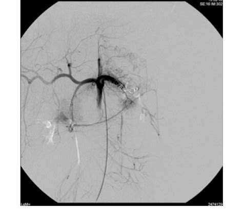 Angiogram After Completion Of Embolization Demonstrating Normal