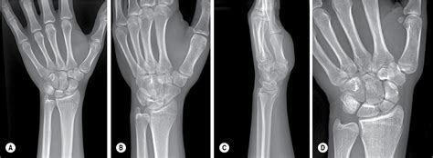 Open Reduction And Internal Fixation Of Acute Scaphoid Fracture Clinical Tree